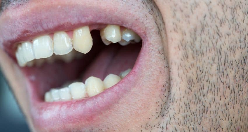 What is the Best Option for Missing Teeth : Complete Guide